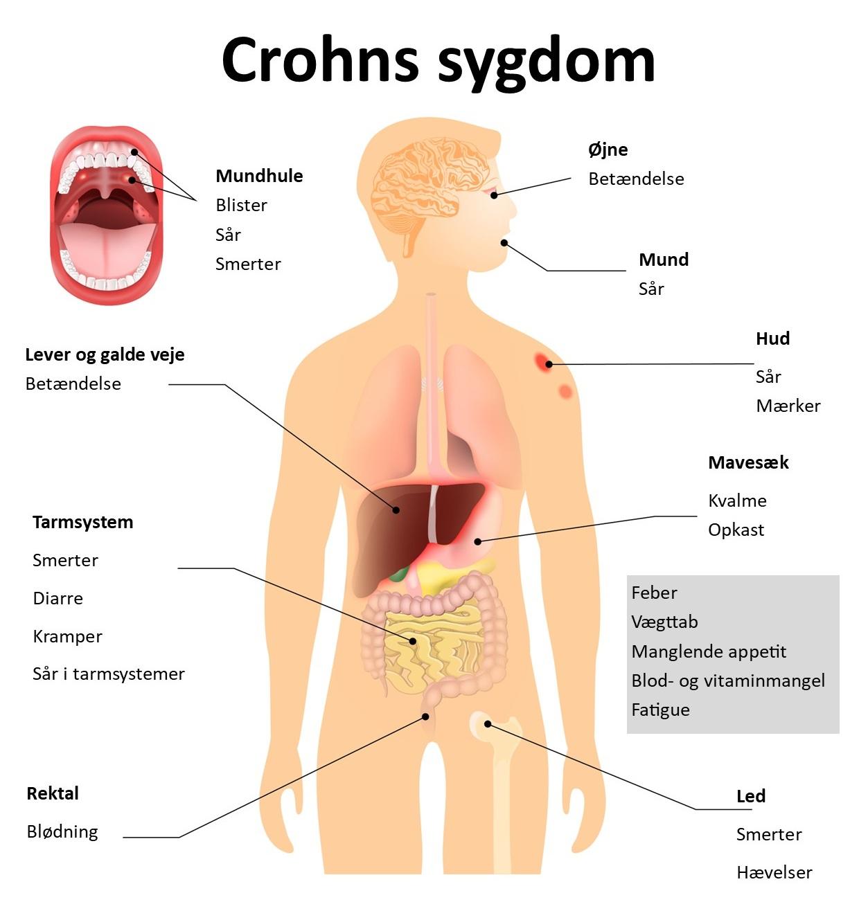 Hvad er Crohns sygdom? | Tarmforeningen Crohn