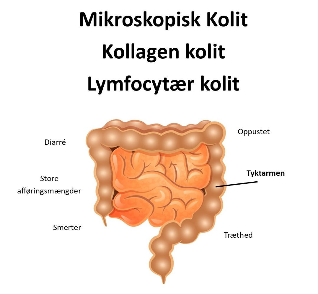 Hvad er mikroskopisk kolit og divertikler? | Tarmforeningen ...